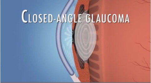 Glaucoma | Central Florida Eye Associates